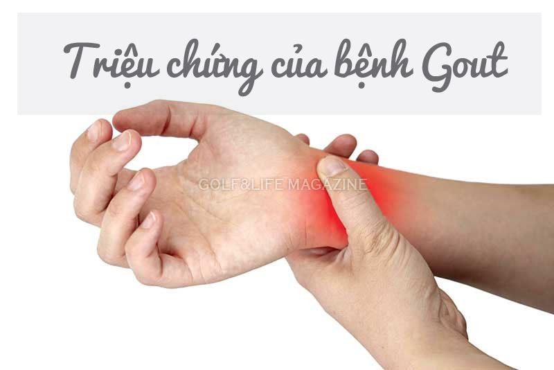 Các triệu chứng của bệnh Gout - Thực phẩm bảo vệ sức khỏe và làm đẹp